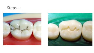 Class i amalgam preps | PPTX