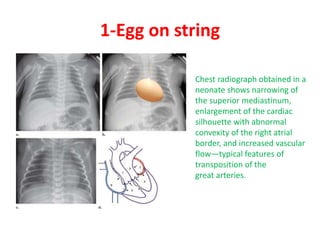 Classical cong.h disease 5th power point presentation (3) | PPTX