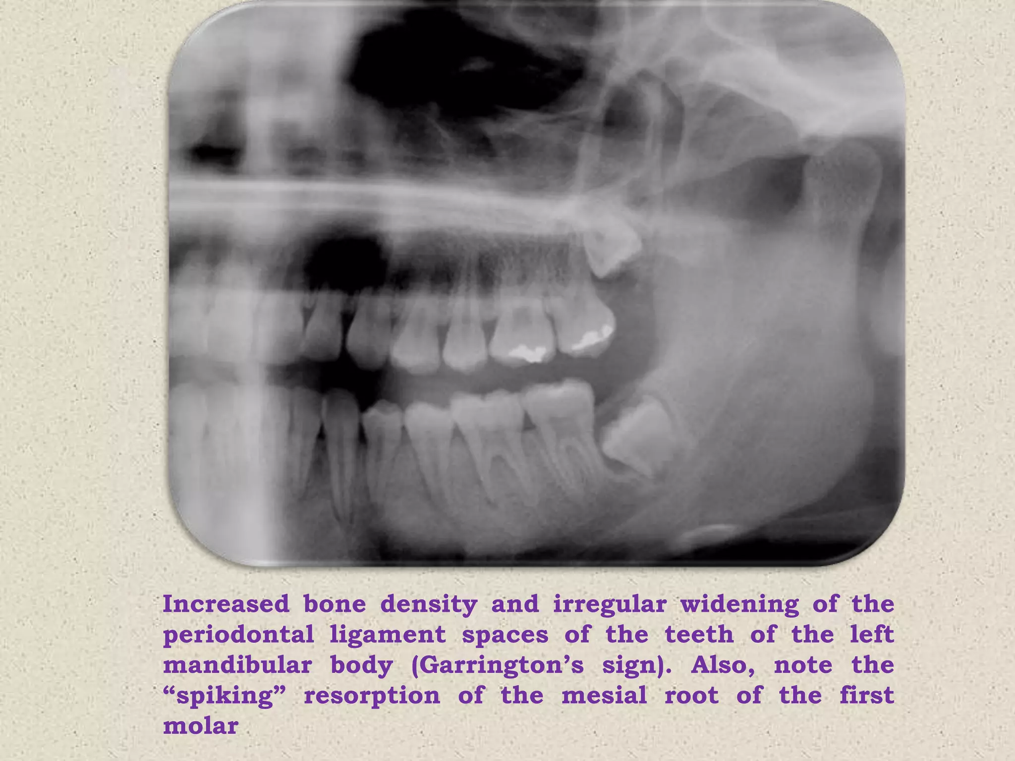 Classical signs in oral and maxillofacial radiology.pptx