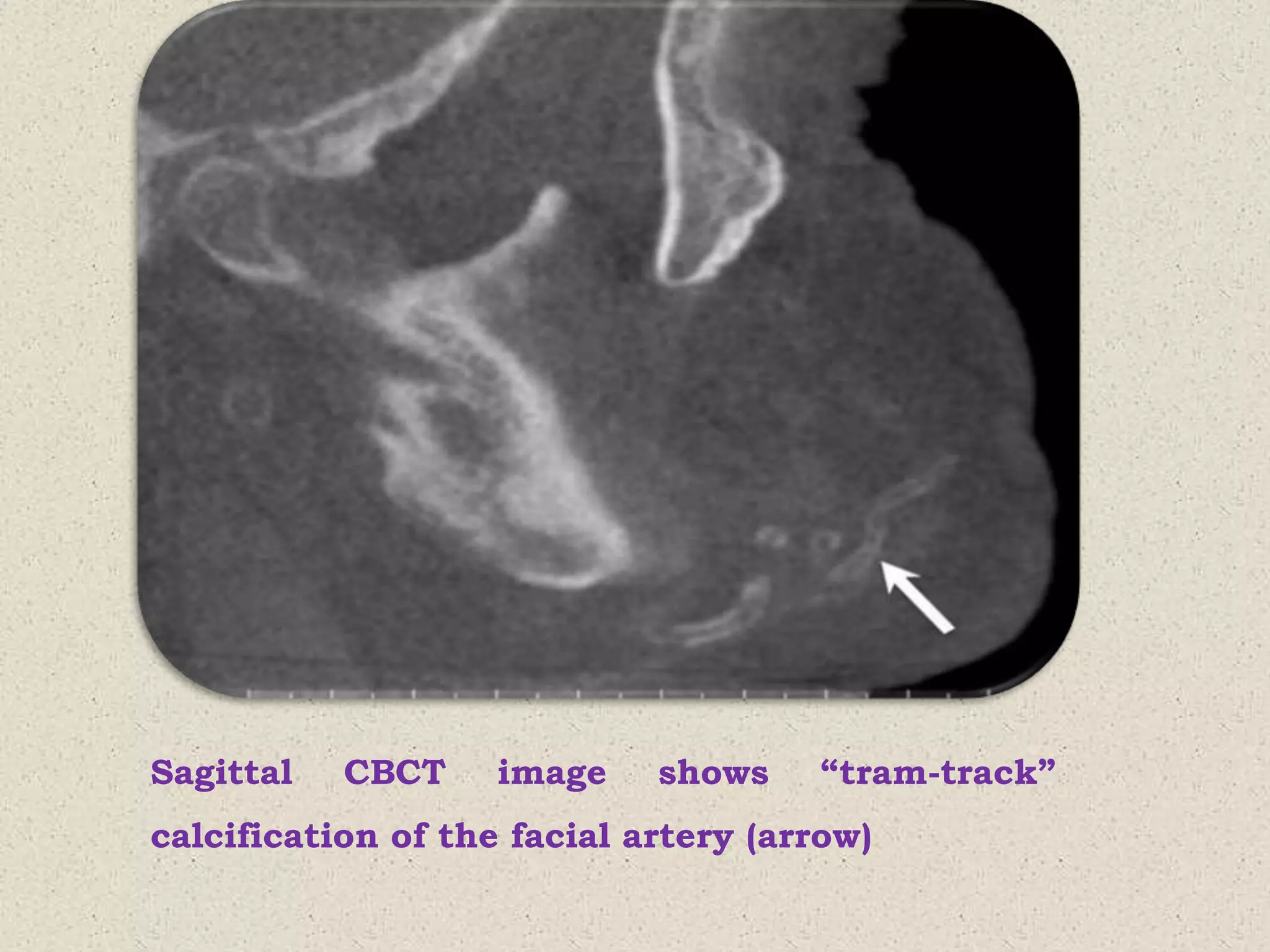 Classical signs in oral and maxillofacial radiology.pptx