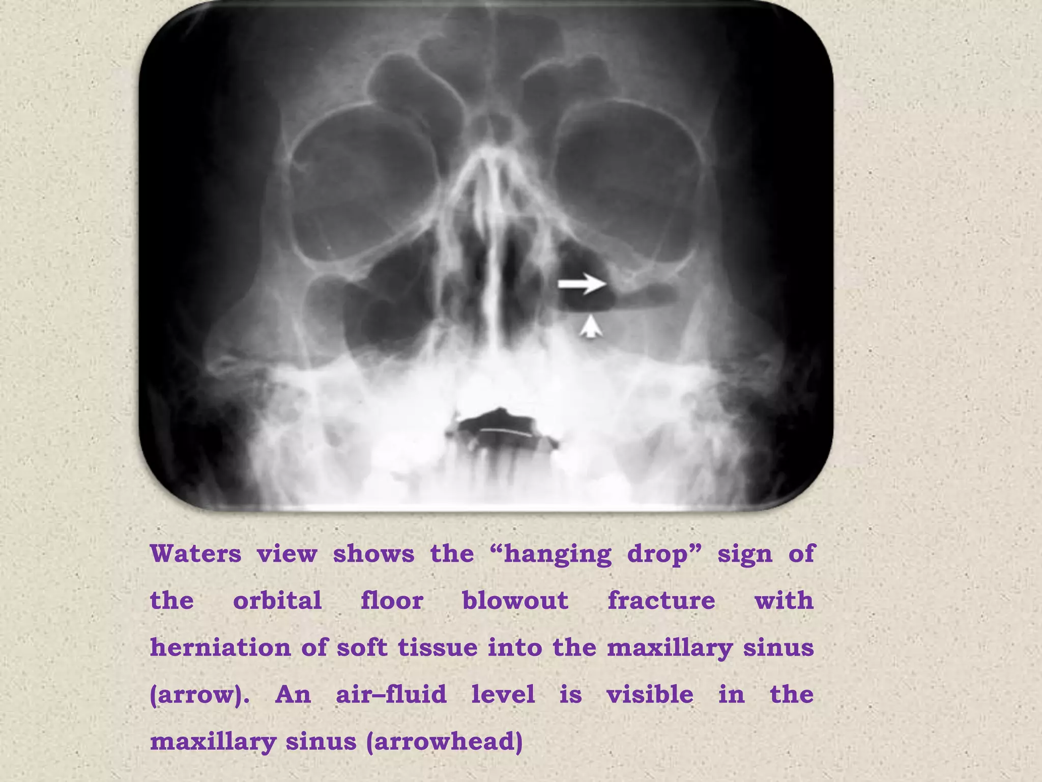 Classical signs in oral and maxillofacial radiology.pptx