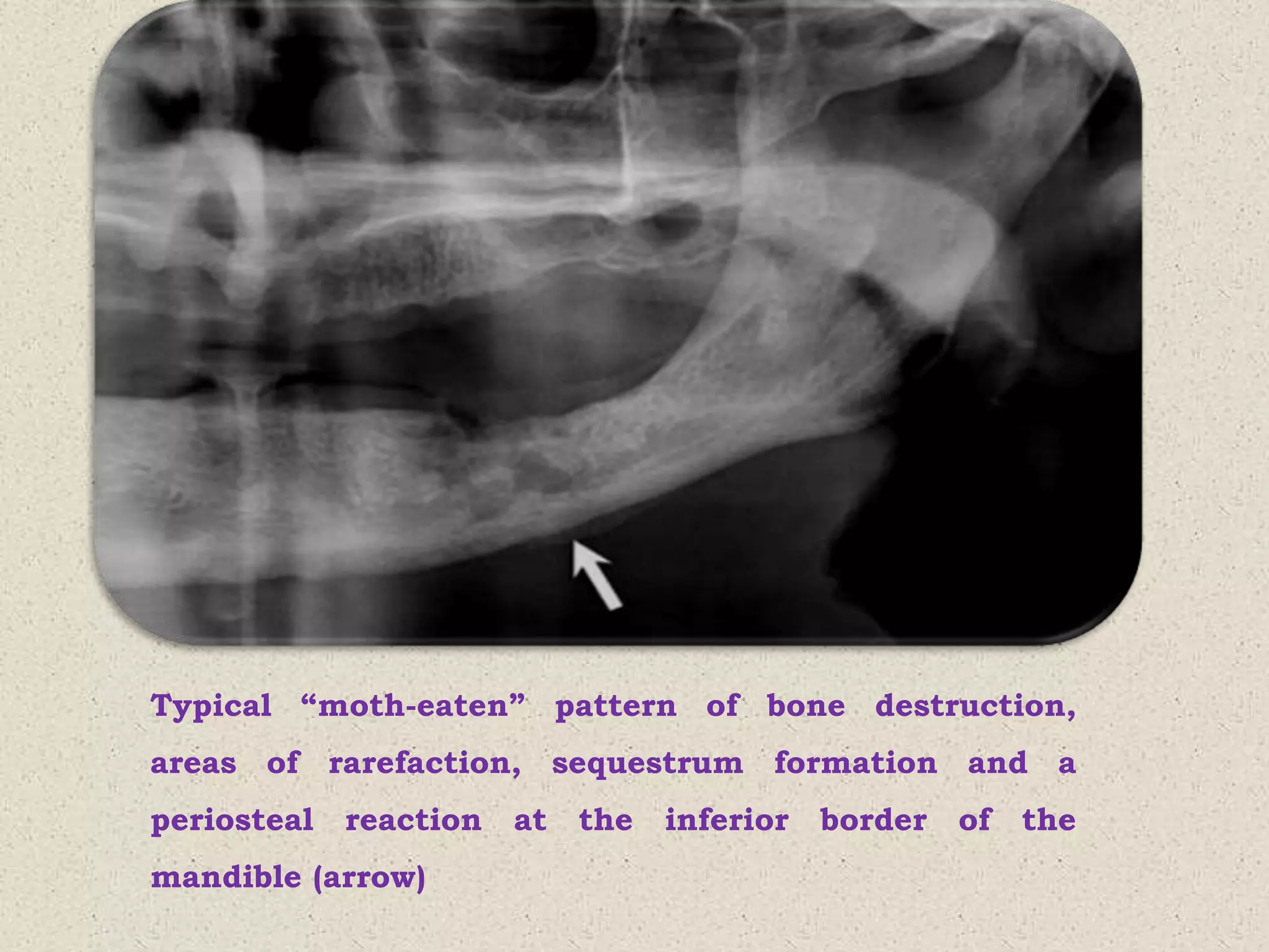 Classical signs in oral and maxillofacial radiology.pptx