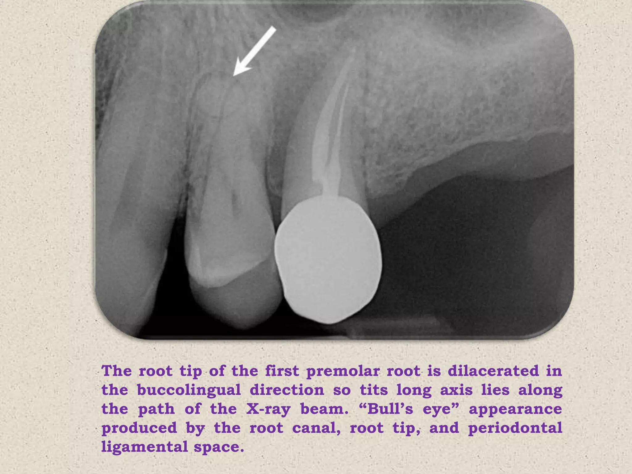 Classical signs in oral and maxillofacial radiology.pptx