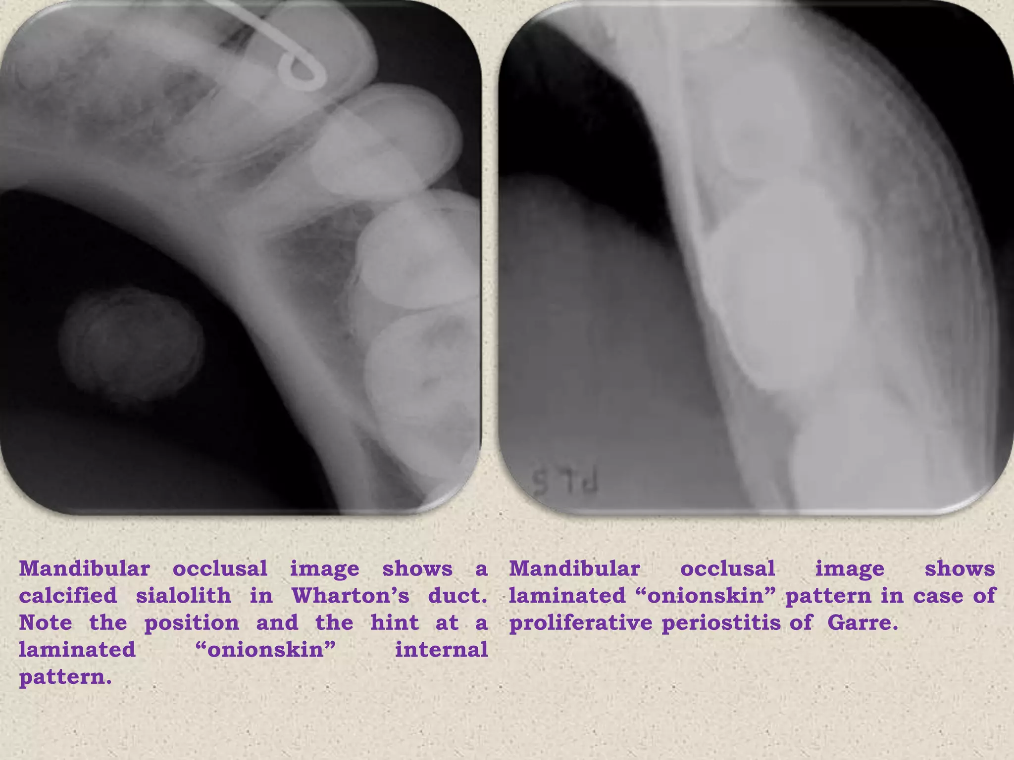 Classical signs in oral and maxillofacial radiology.pptx