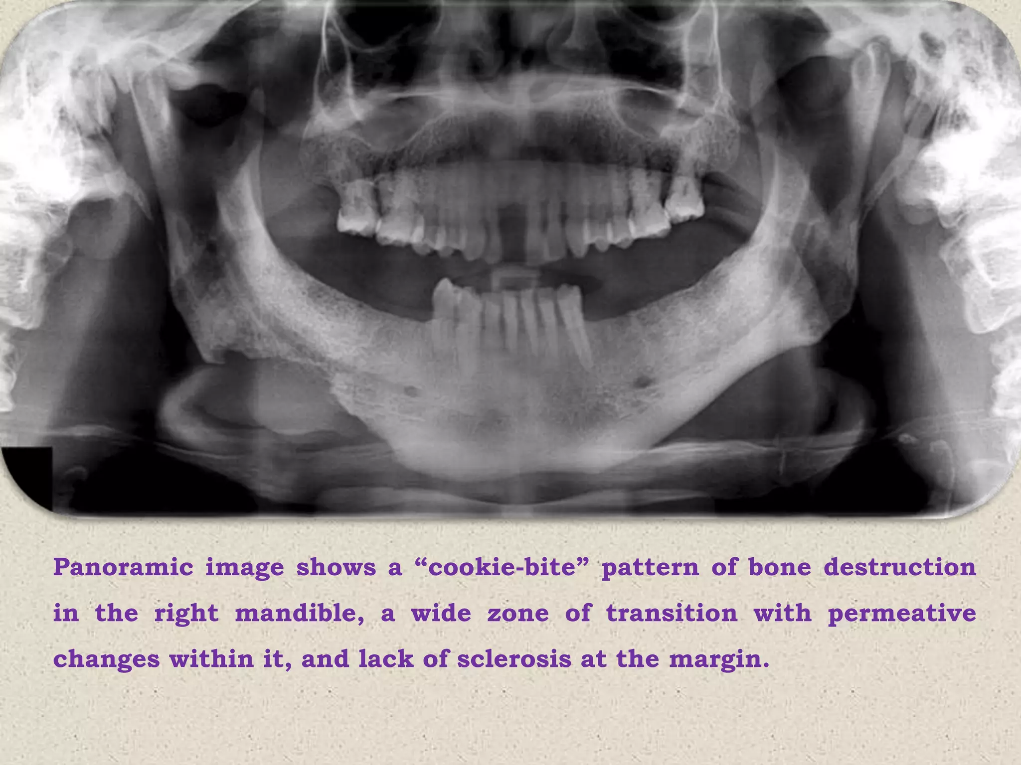 Classical signs in oral and maxillofacial radiology.pptx