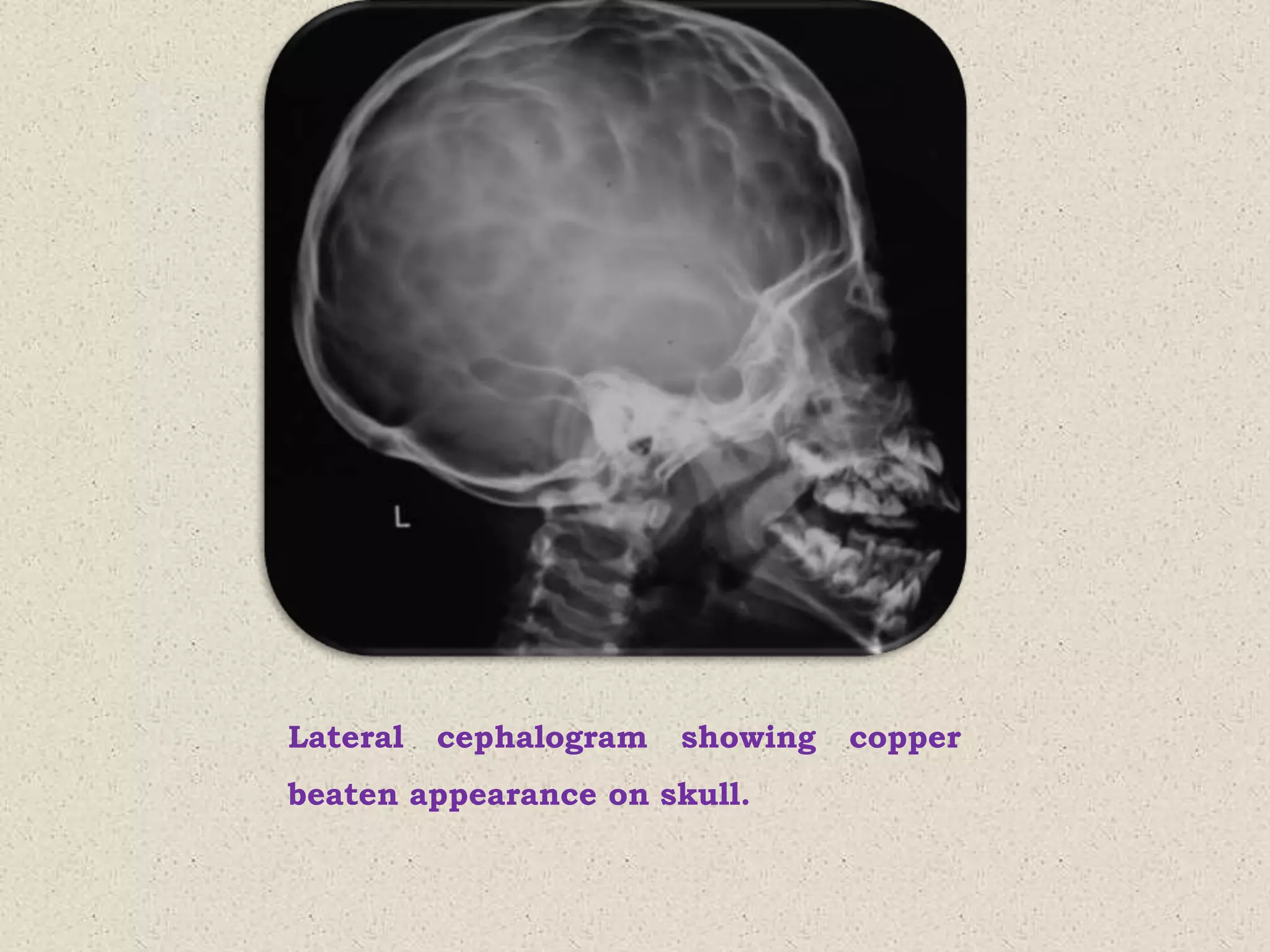 Classical signs in oral and maxillofacial radiology.pptx