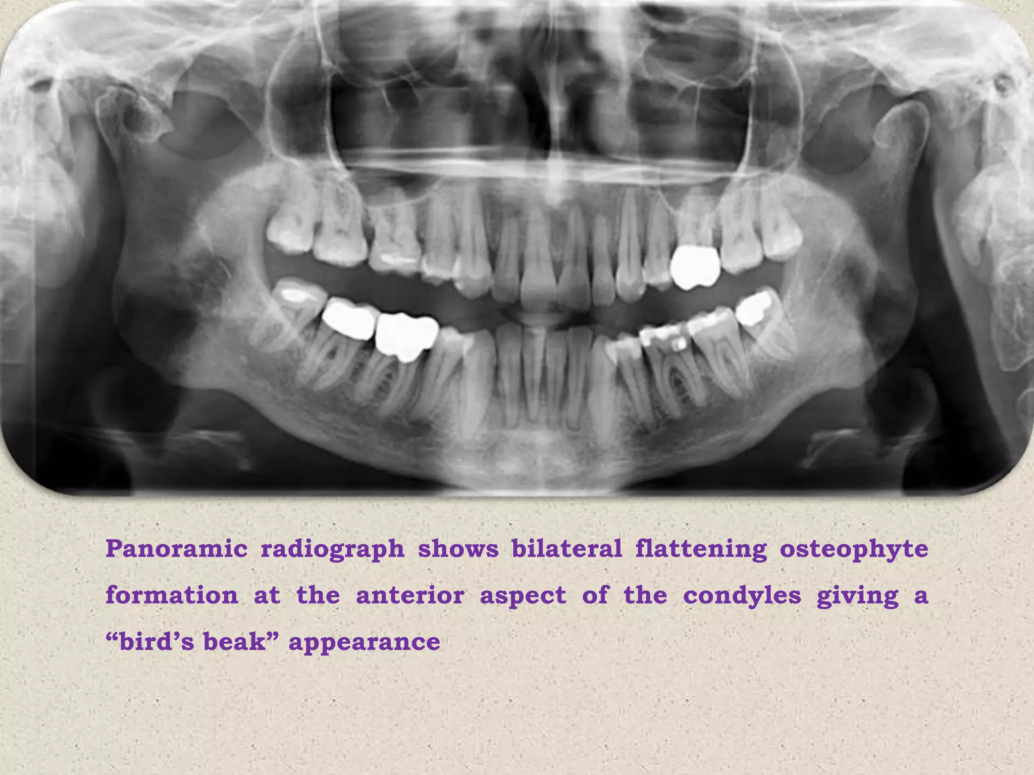 Classical signs in oral and maxillofacial radiology.pptx