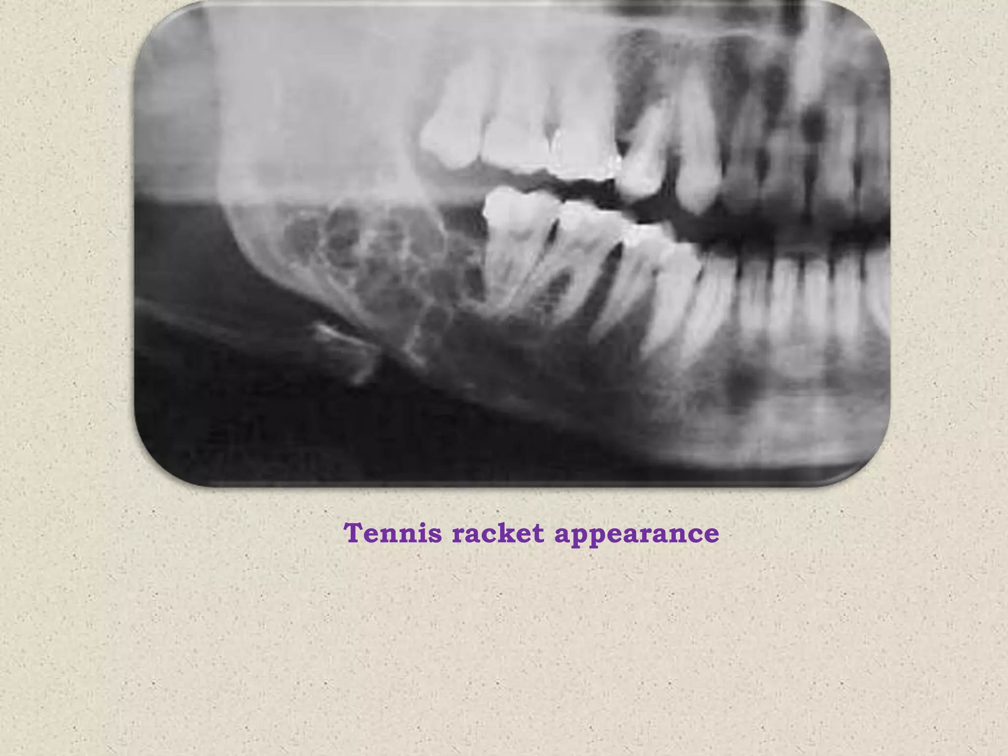 Classical signs in oral and maxillofacial radiology.pptx