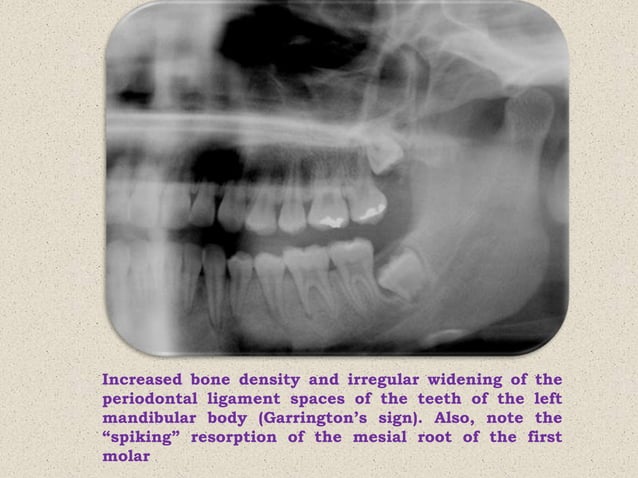 Classical signs in oral and maxillofacial radiology.pptx | Bone and ...