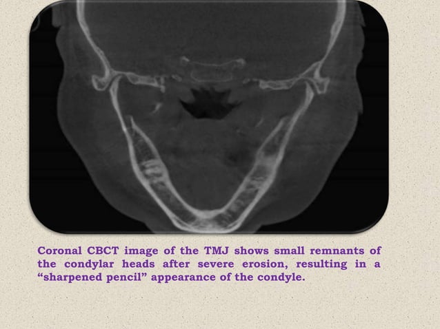 Classical signs in oral and maxillofacial radiology.pptx | Bone and ...
