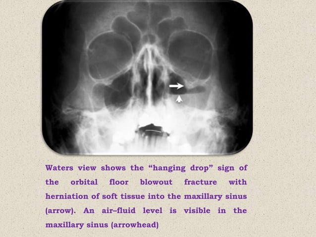 Classical signs in oral and maxillofacial radiology.pptx | Bone and ...