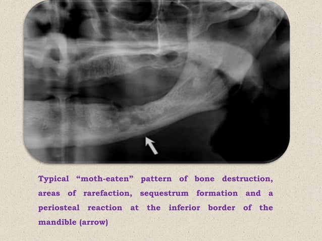 Classical signs in oral and maxillofacial radiology.pptx | Bone and ...