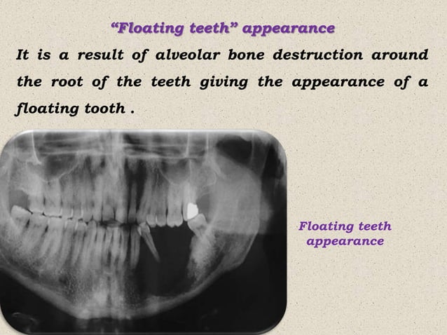 Classical signs in oral and maxillofacial radiology.pptx | Bone and ...