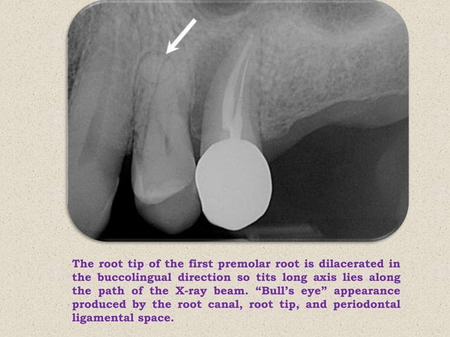 Classical signs in oral and maxillofacial radiology.pptx | Bone and ...