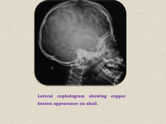 Classical signs in oral and maxillofacial radiology.pptx | Bone and ...