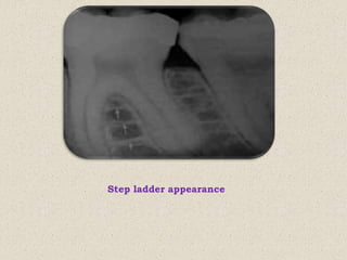 Classical signs in oral and maxillofacial radiology.pptx