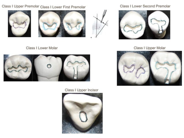 Class i cavity prep1