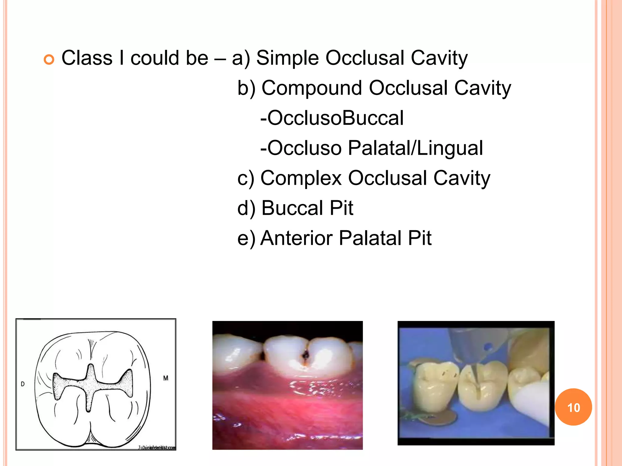 Class i cavity preparation | PPTX