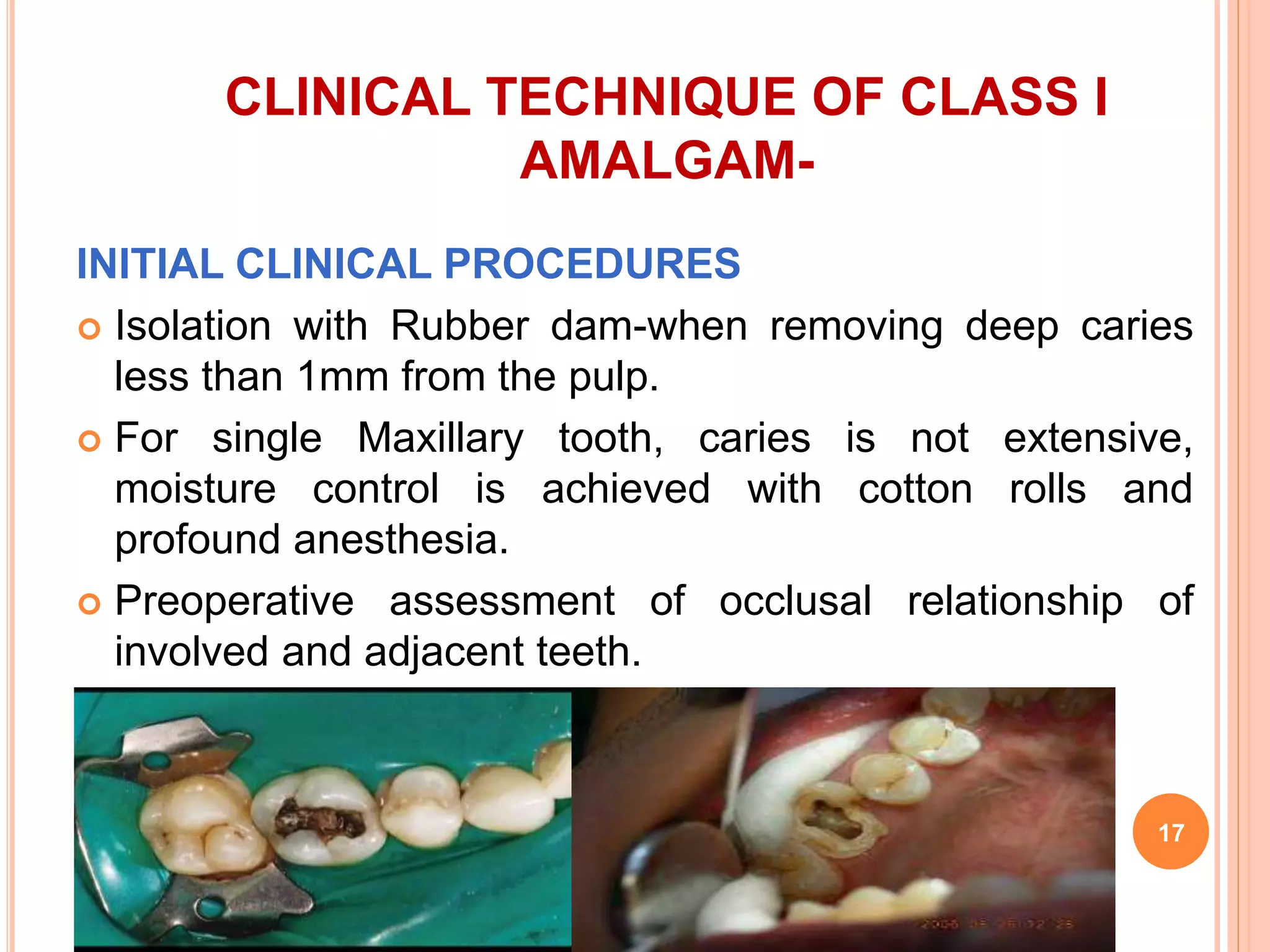 Class i cavity preparation | PPTX