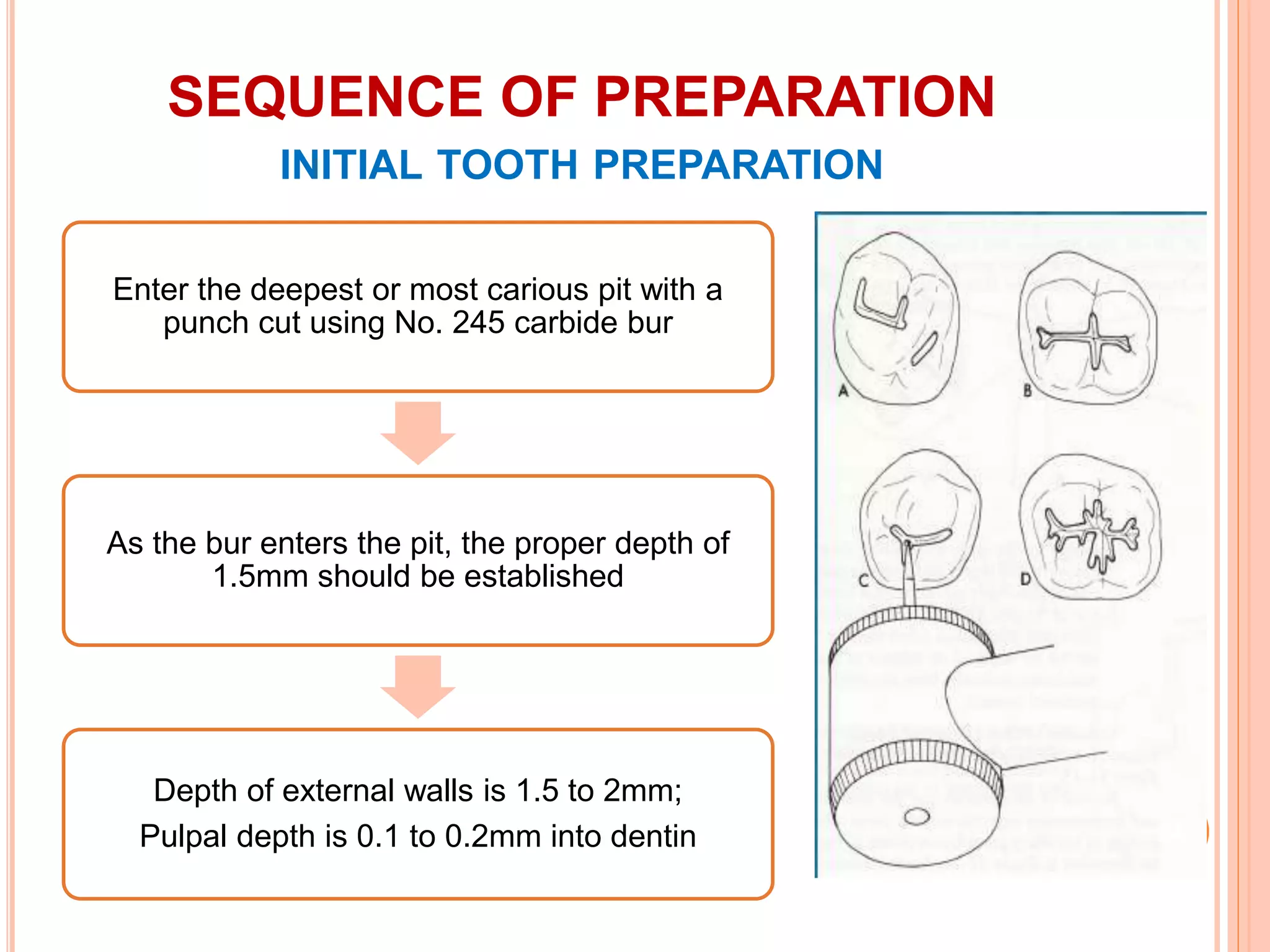 Class i cavity preparation | PPTX