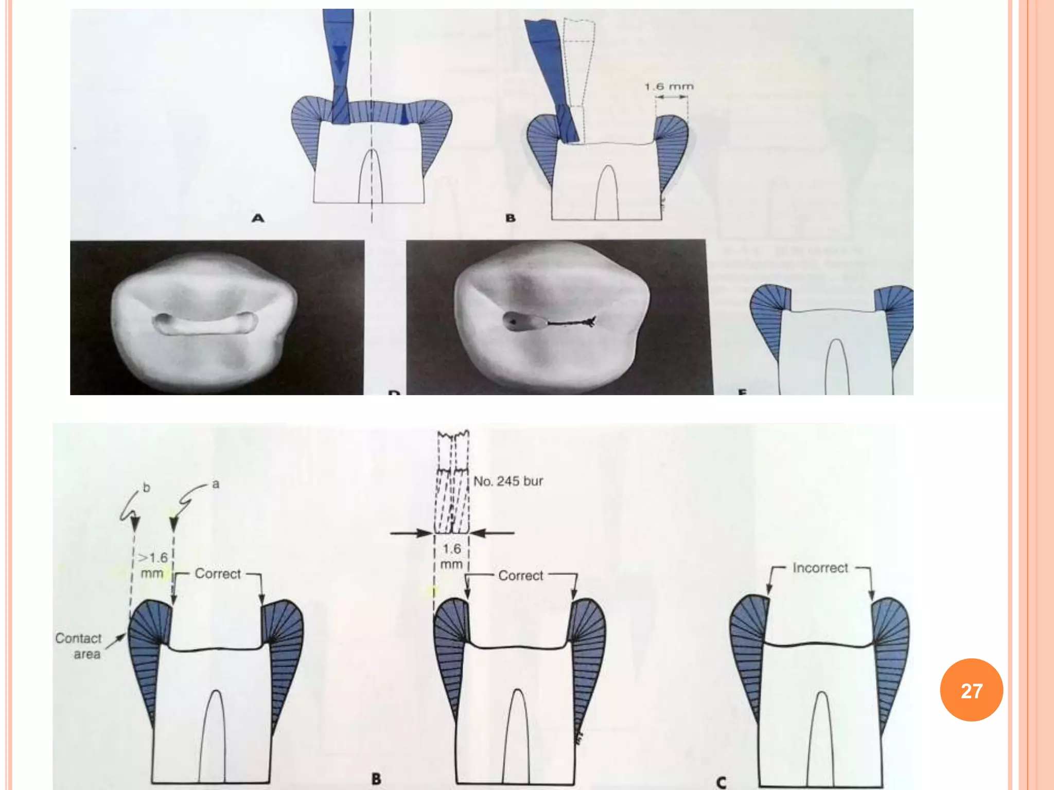 Class i cavity preparation | PPTX