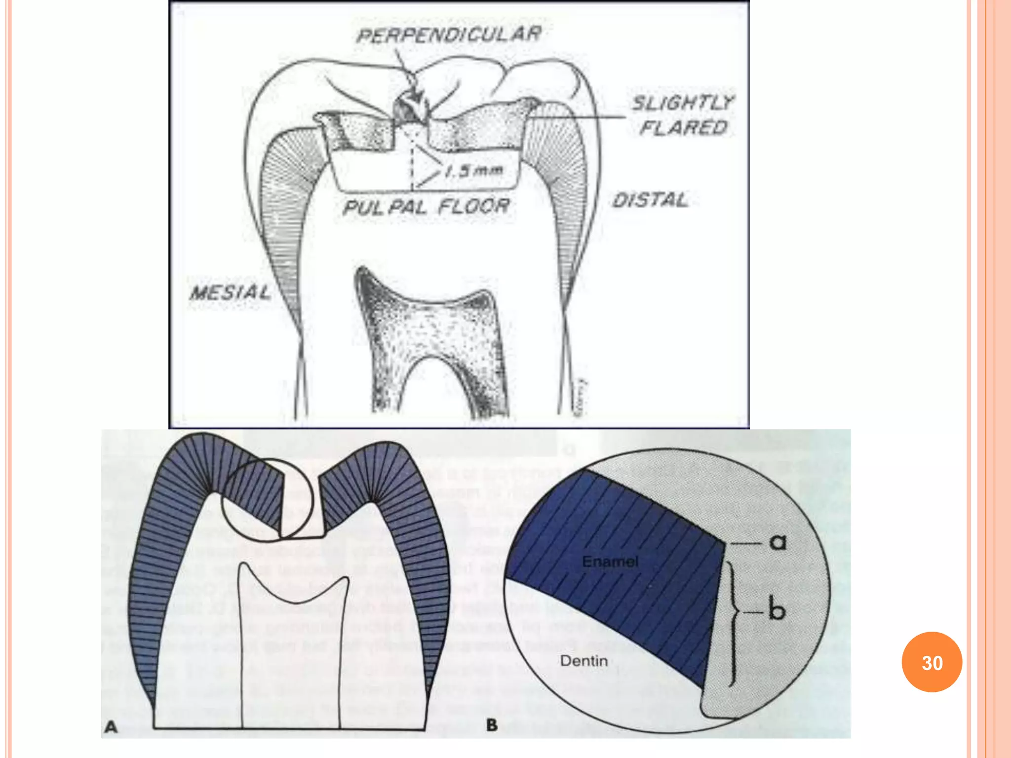 Class i cavity preparation | PPTX