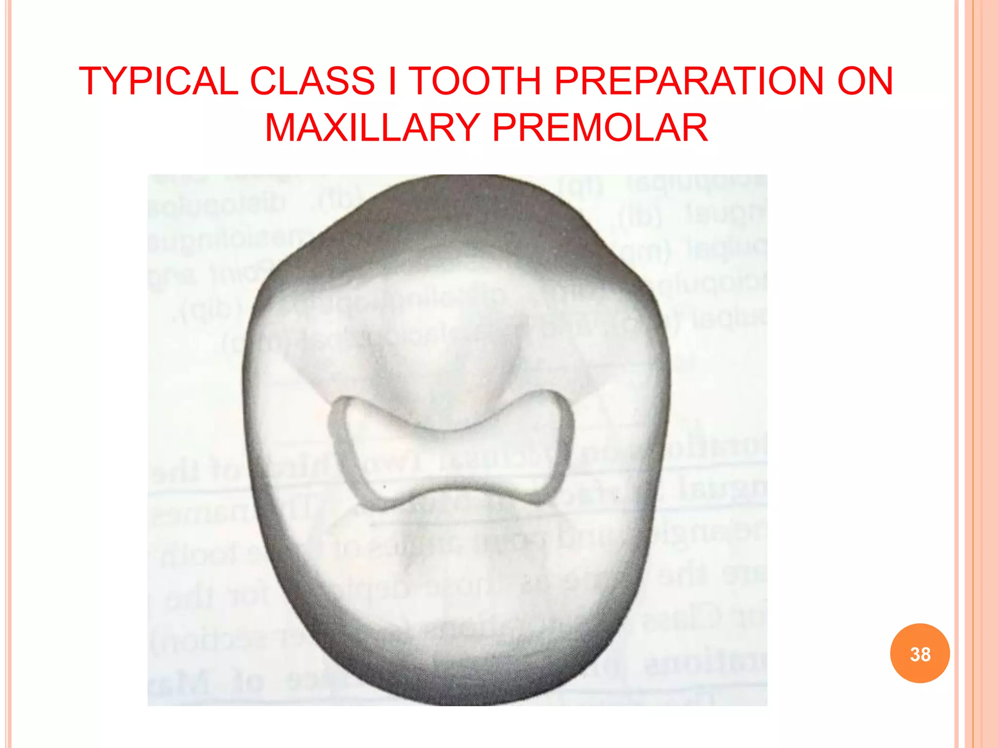 Class i cavity preparation | PPTX