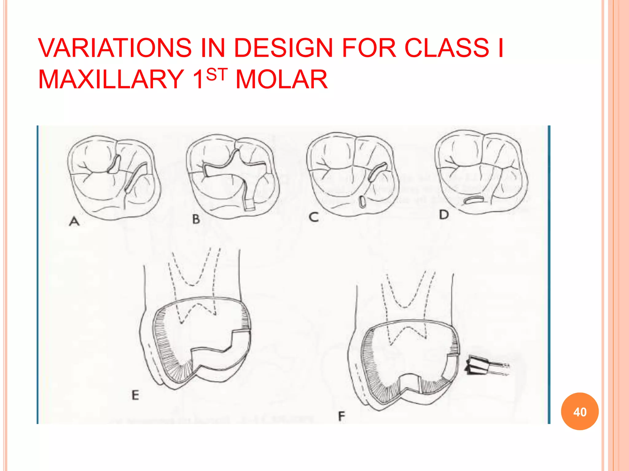 Class i cavity preparation | PPTX