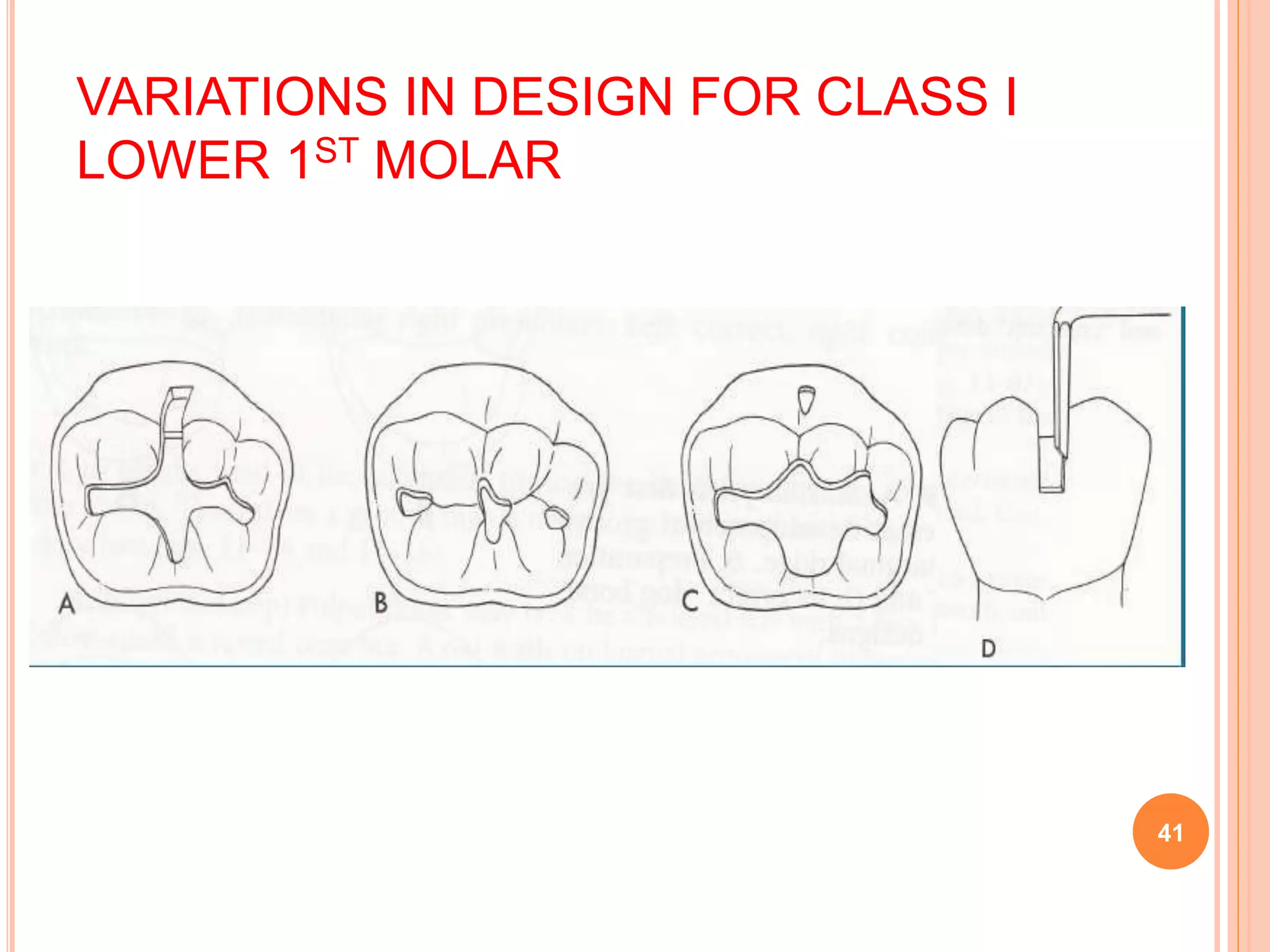 Class i cavity preparation | PPTX