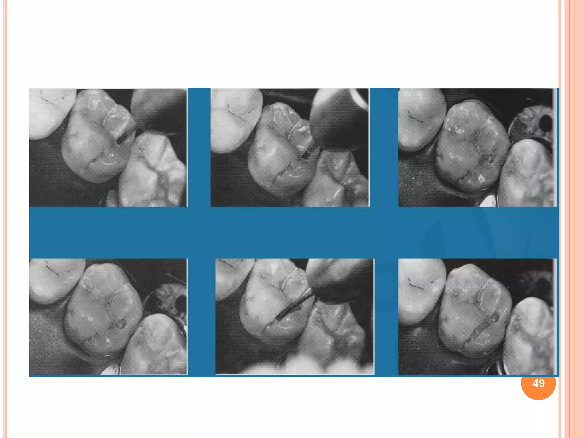 Class i cavity preparation | PPTX