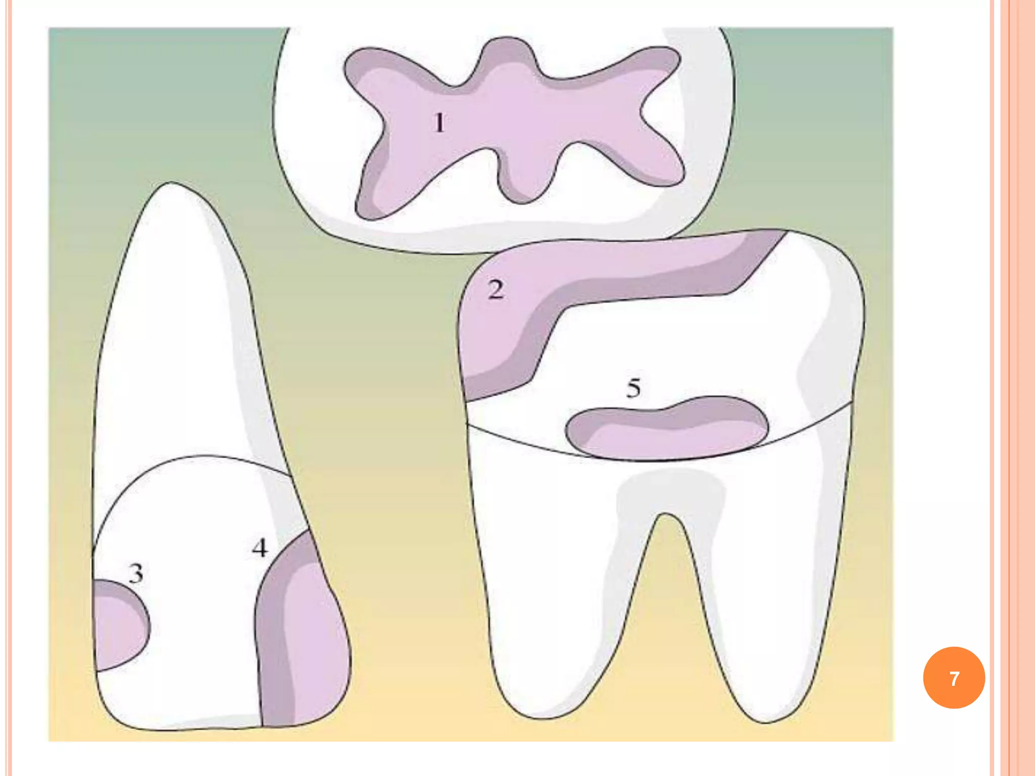 Class i cavity preparation | PPTX