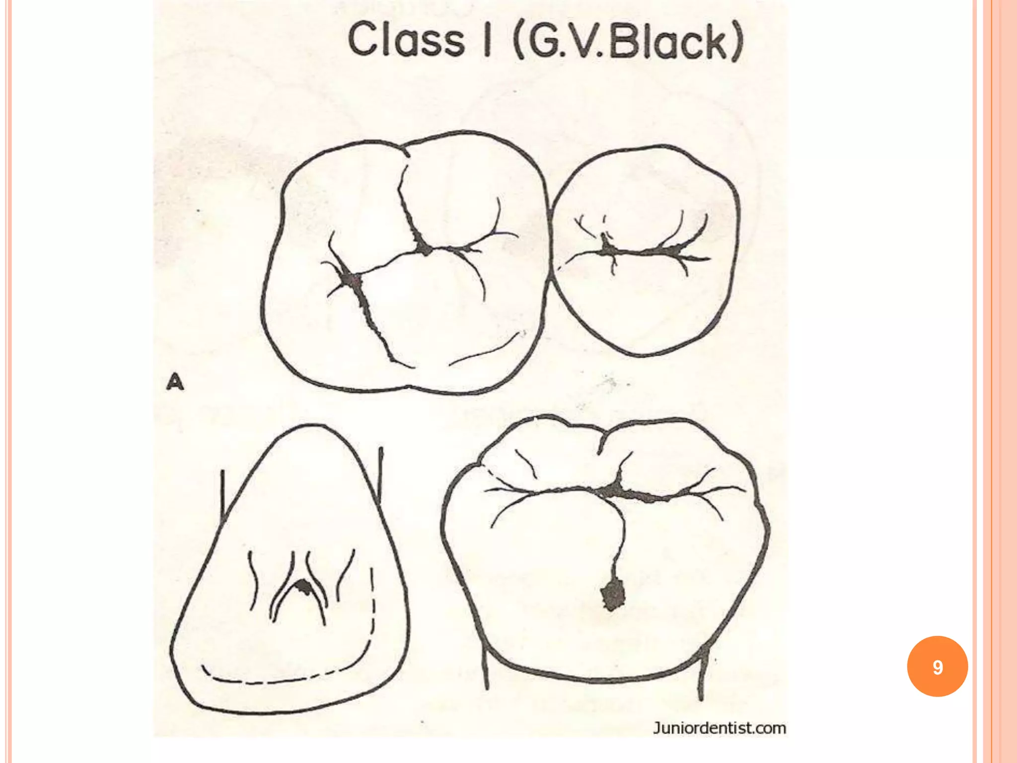 Class i cavity preparation | PPTX