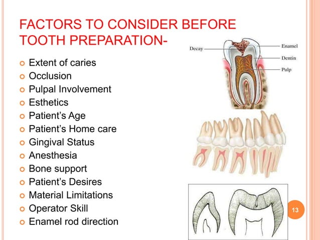 Class i cavity preparation | PPTX