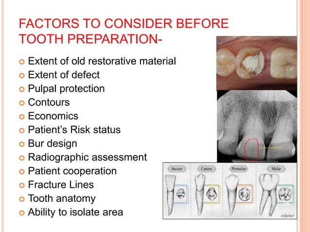 Class i cavity preparation | PPTX