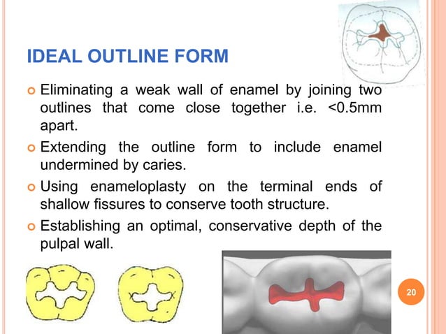 Class i cavity preparation | PPTX