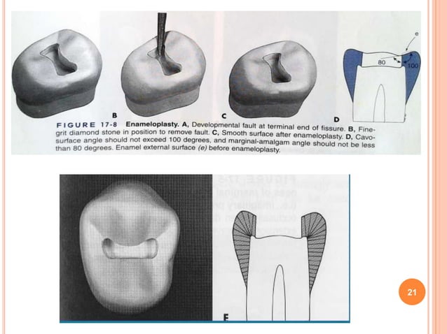 Class i cavity preparation | PPTX