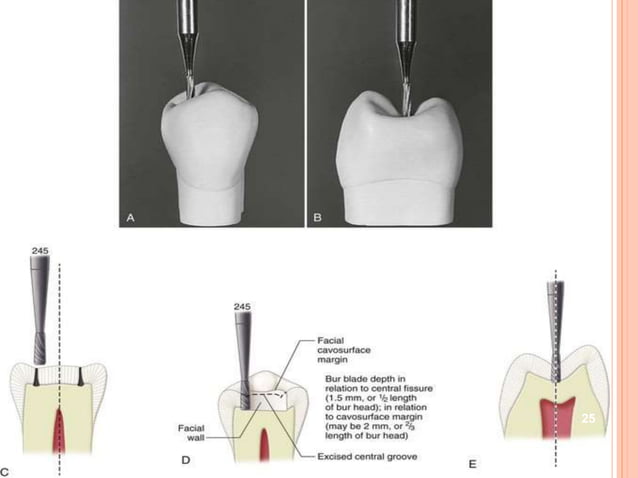Class i cavity preparation | PPTX