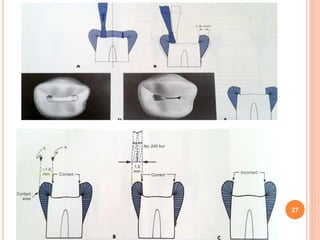 Class i cavity preparation | PPTX