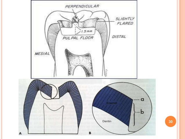Class i cavity preparation | PPTX