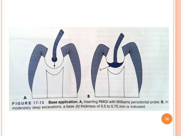 Class i cavity preparation | PPTX
