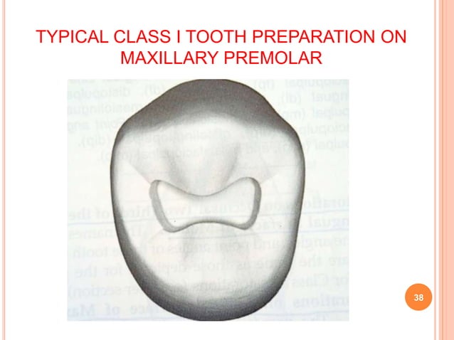 Class i cavity preparation | PPTX