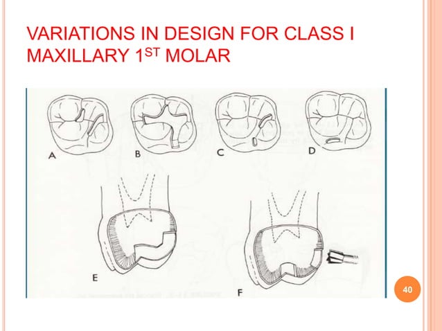 Class i cavity preparation | PPTX