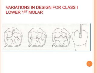 Class i cavity preparation | PPTX