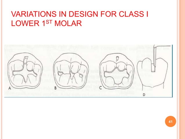 Class i cavity preparation | PPTX