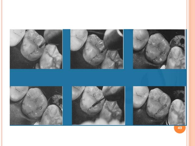 Class i cavity preparation | PPTX
