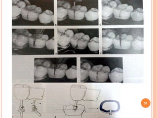 Class i cavity preparation | PPTX