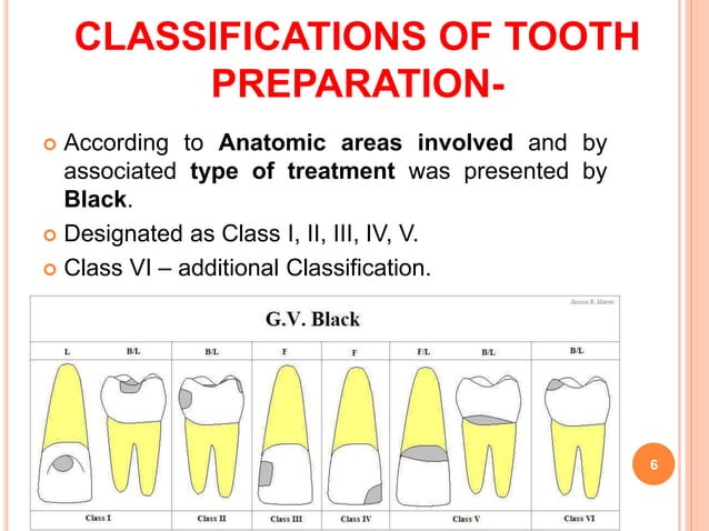 Class i cavity preparation | PPTX
