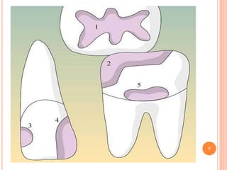 Class i cavity preparation | PPTX