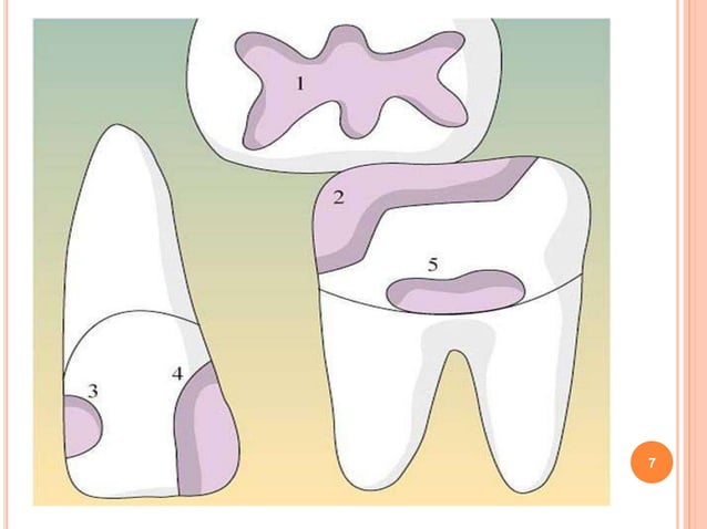 Class i cavity preparation | PPTX