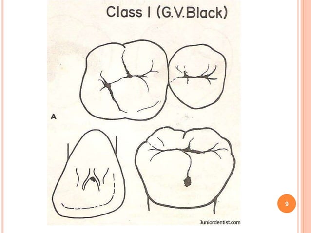 Class i cavity preparation | PPTX